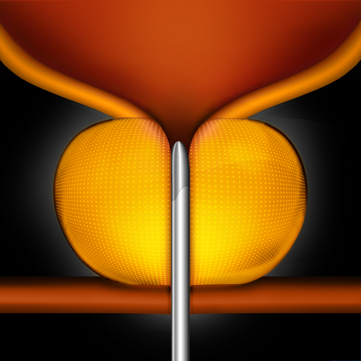 Urolift System for BPH | Enlarged Prostate | BPH Treatment