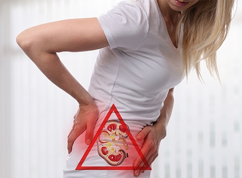 Kidney Stones Specialist Columbus Ohio | Signs of Kidney Stones